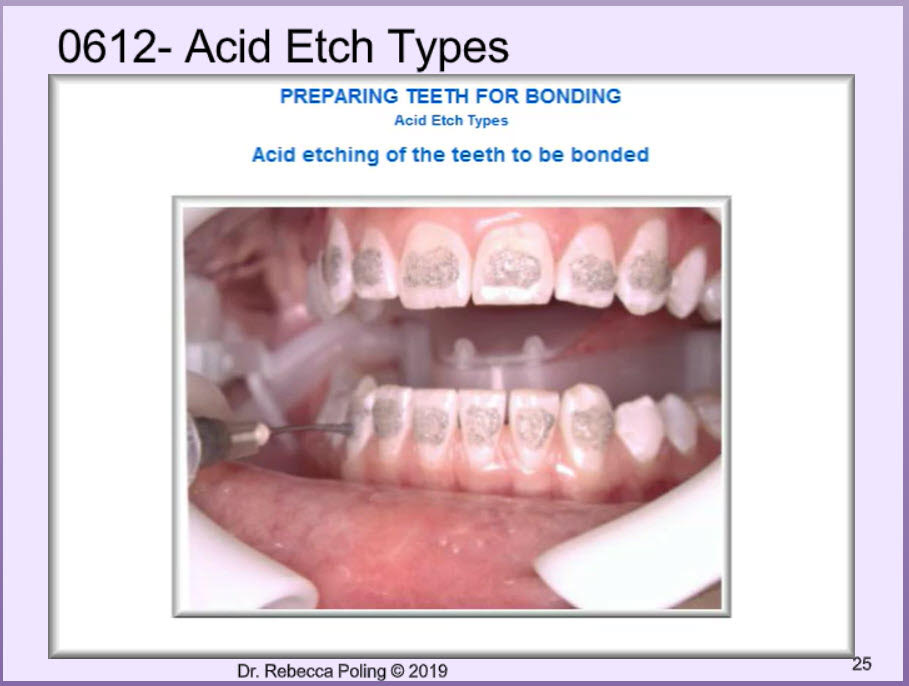 60.20 Orthodontic Bonding - Product Details - OrthoTraining